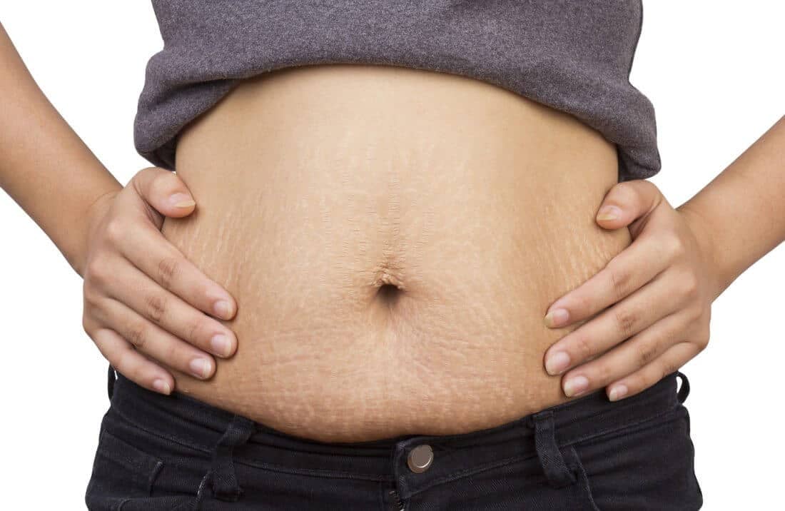 The Truth About Stretch Marks: What You Really Need To Know About Them